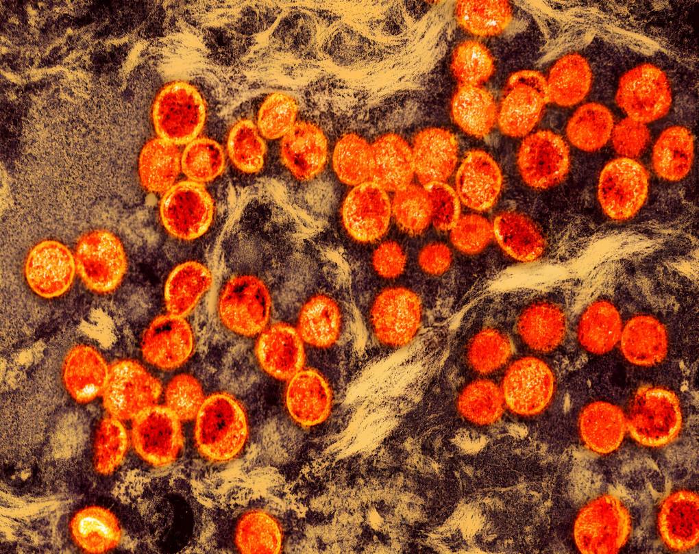 The 1st US Clade I Mpox Case Has Been Found in the Bay Area. Here’s What to Know | KQED