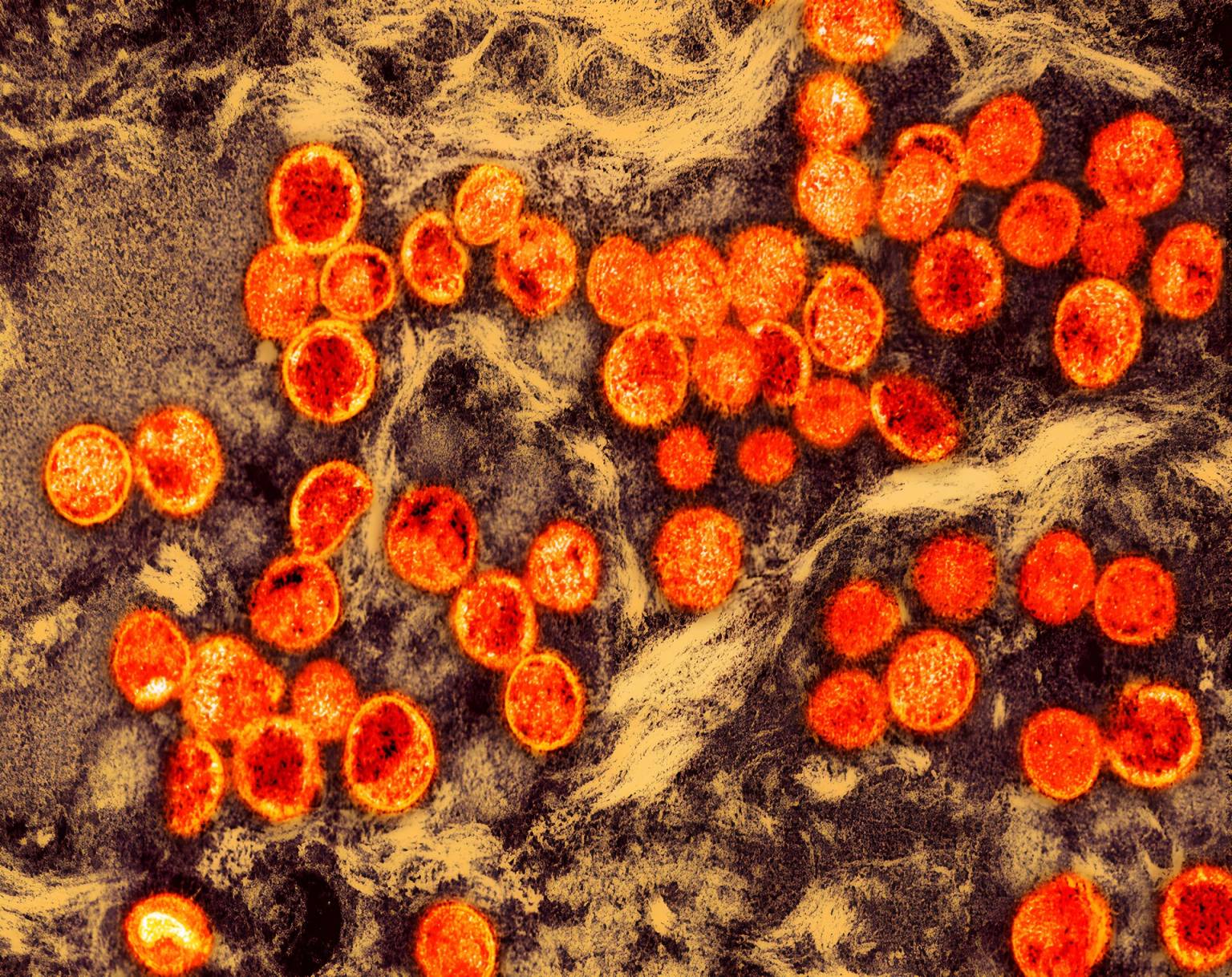3 Cases of More Severe Mpox Strain Found in California — Here's What to ...